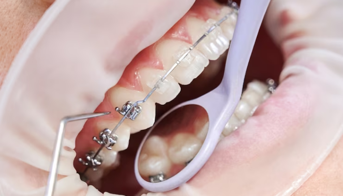 Ortodoncia fija – DENTAL GRAN VIA